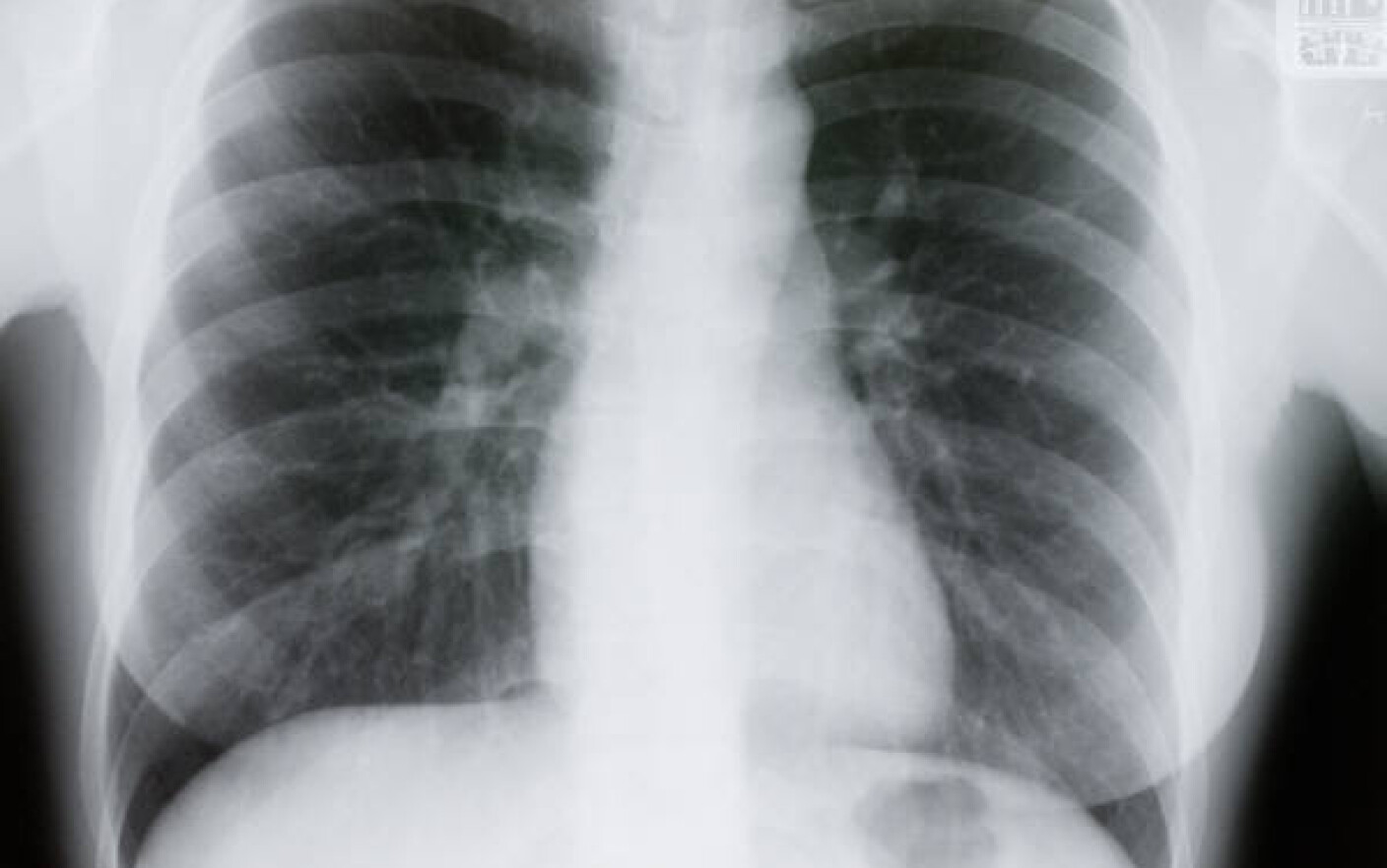 O infectie respiratorie banala poate ascunde o boala grava. Radiografia ...