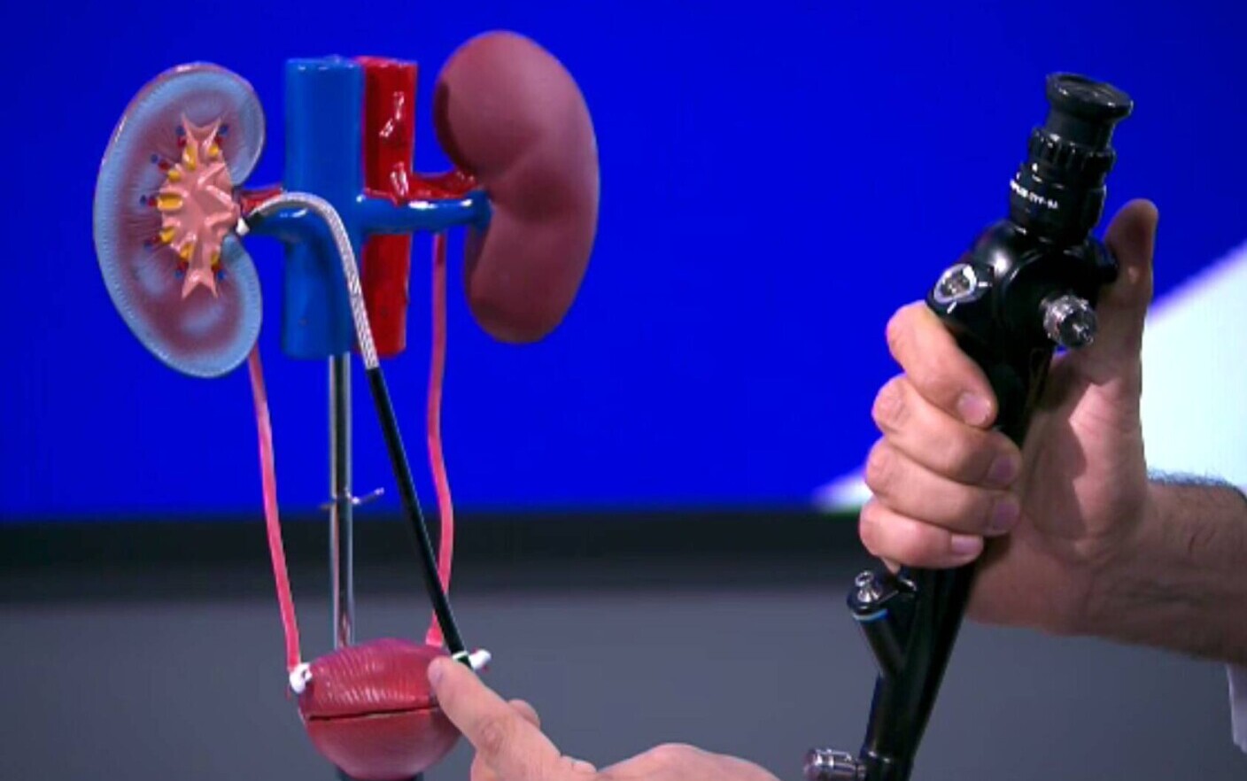 Una din zece persoane face pietre la rinichi. Cum se pot elimina prin ...