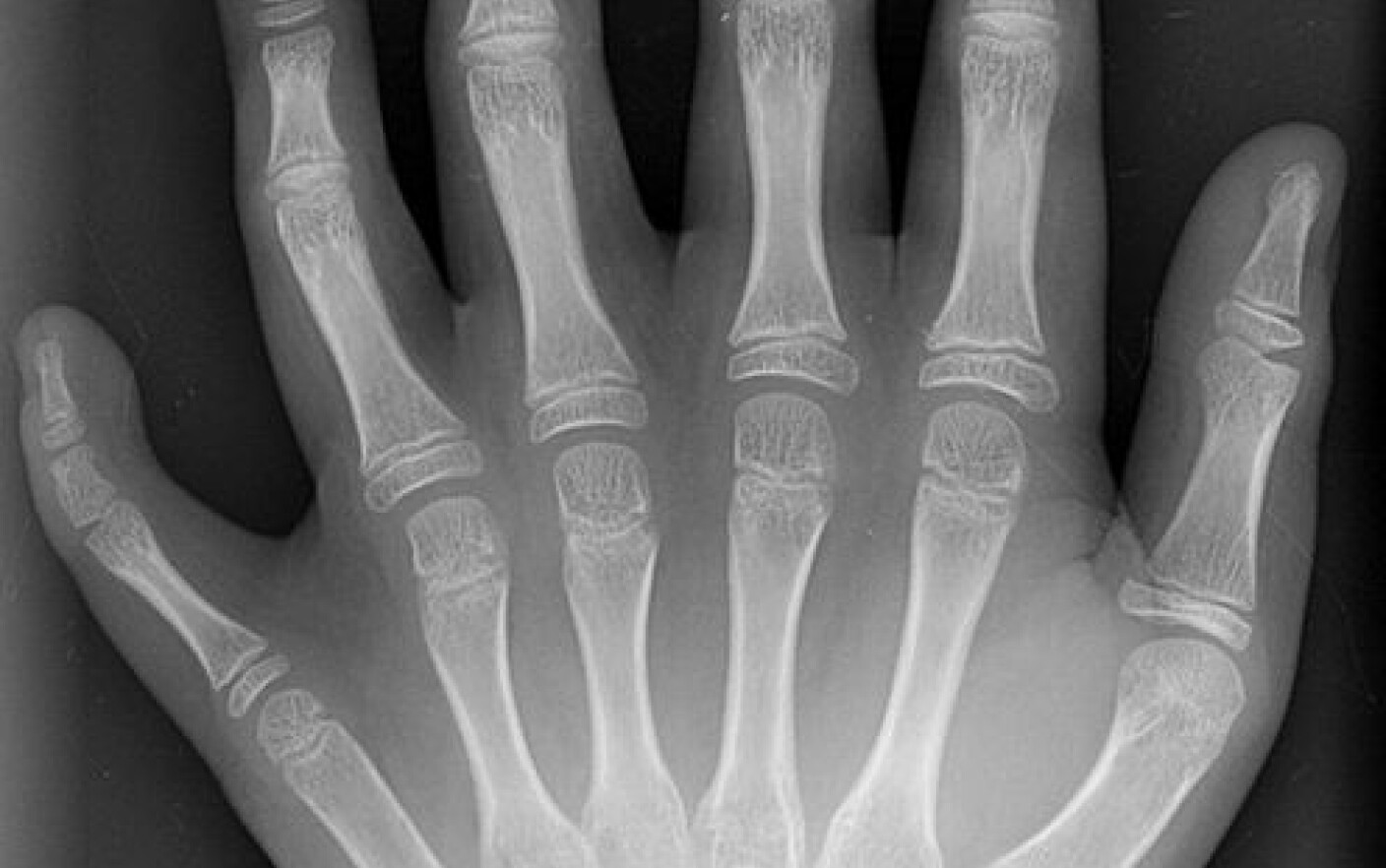 S-a nascut cu 12 degete la maini si 12 la picioare! - Stirileprotv.ro