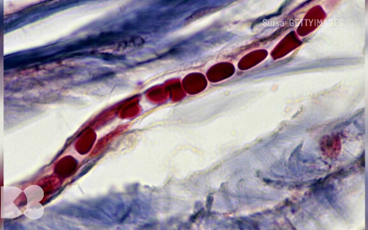 Atero-scleroză și principalul factor care o produce. Explicațiile ...