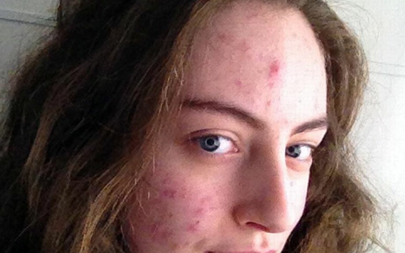 Sufera de o forma severa de acnee si nu iese din casa fara machiaj. Cum ...