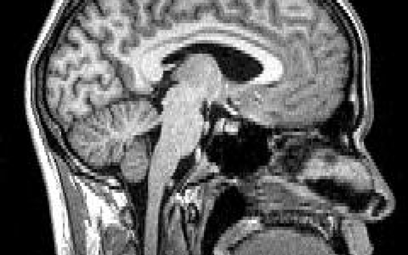 Ce au gasit medicii in creierul unei paciente. "Nu ne-am fi gandit ...