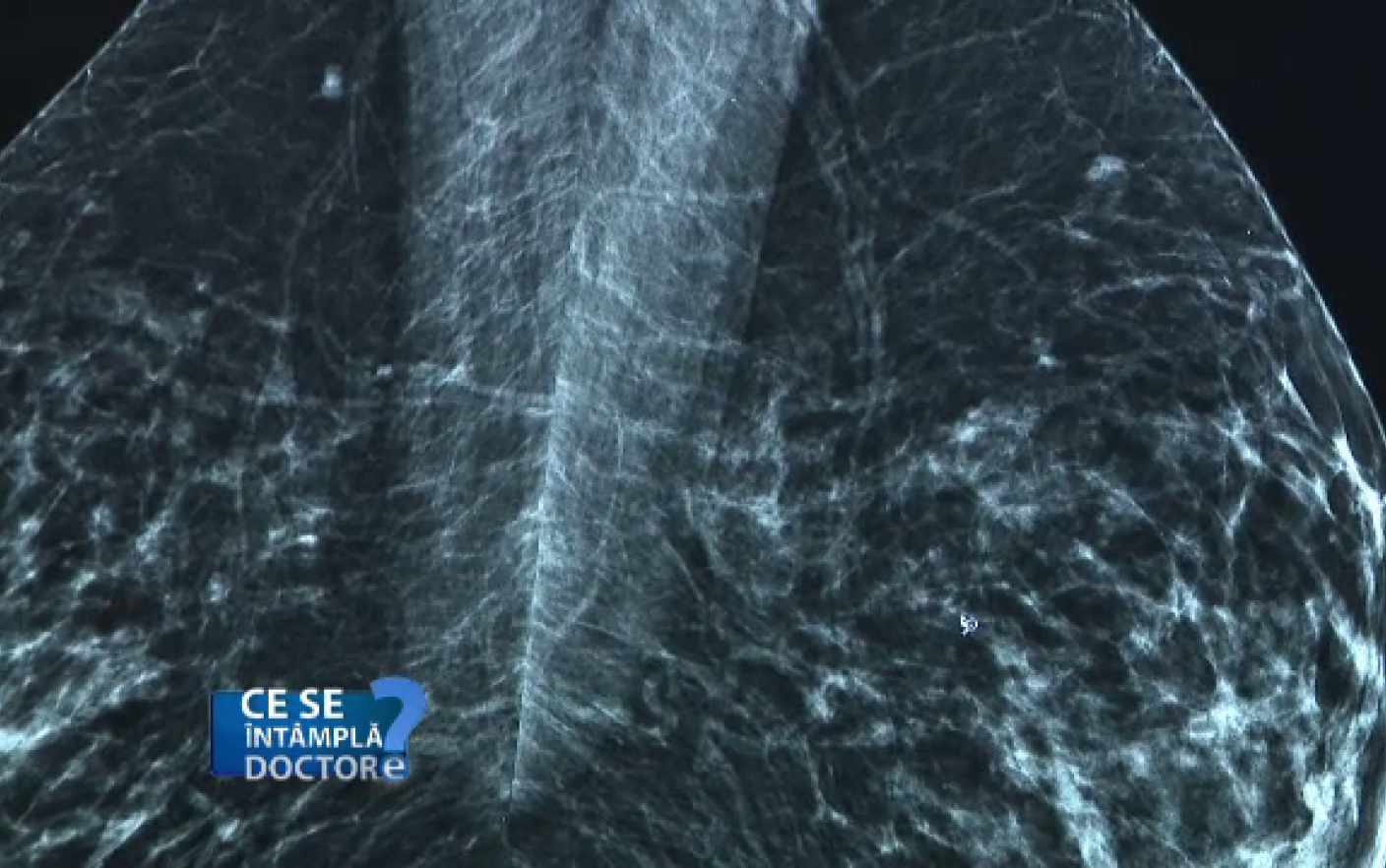 Cancerul la san nu poate fi prevenit, dar exista posibilitatea unui ...