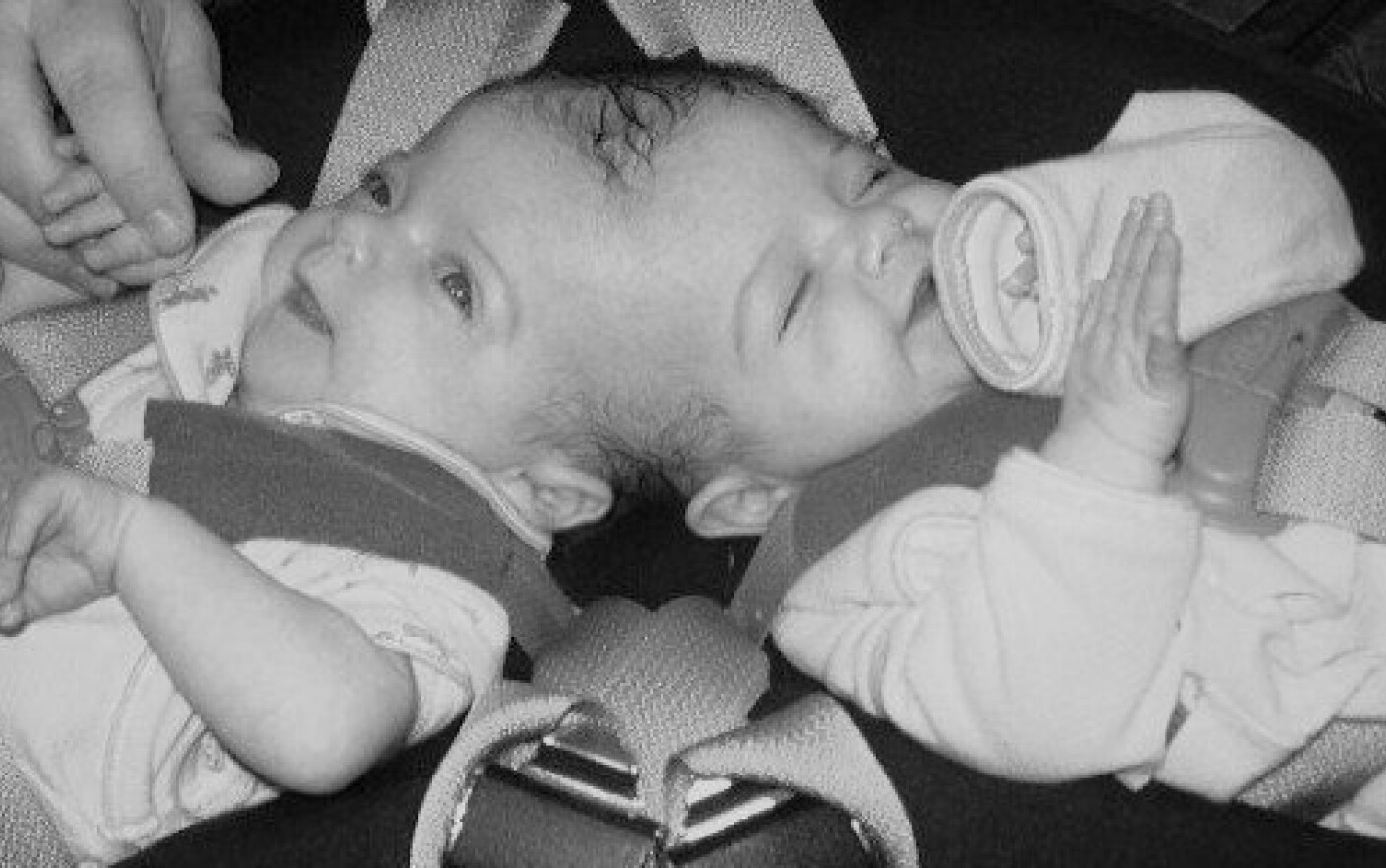 Fascinant! Povestea siamezelor care au acelasi creier, ganduri si ...