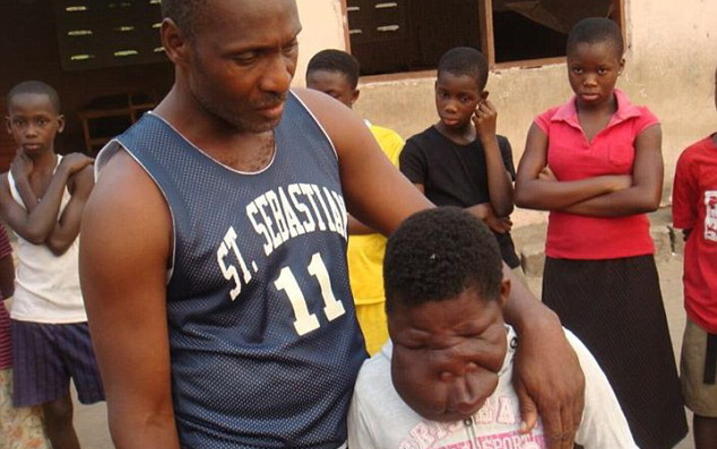 Fetita de 13 ani din Ghana cu o diformitate faciala extrema va fi ...