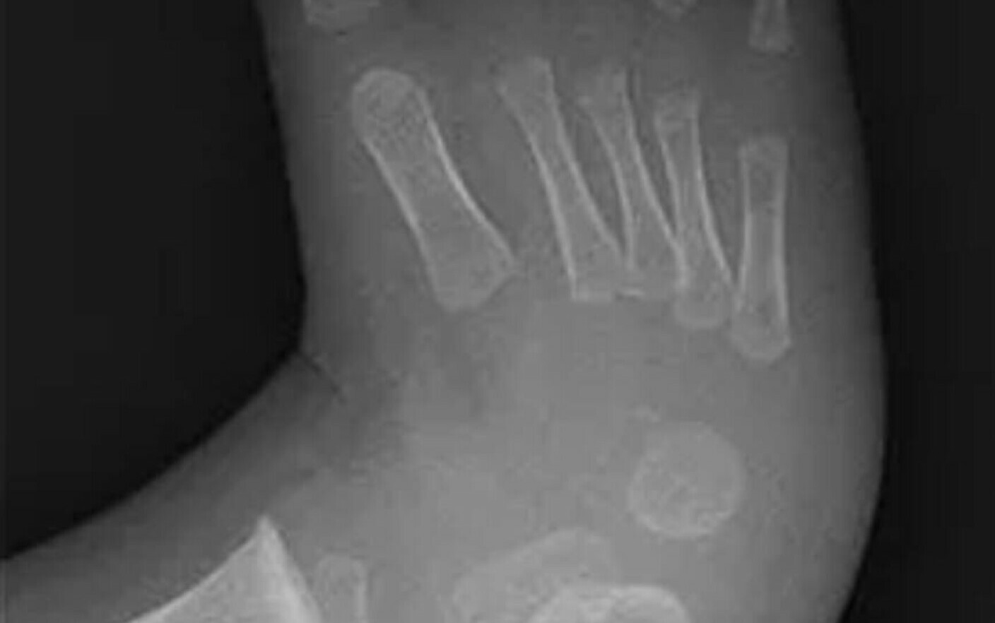 (P) Tratamentul pentru picior Varus Equin la bebeluși - Stirileprotv.ro