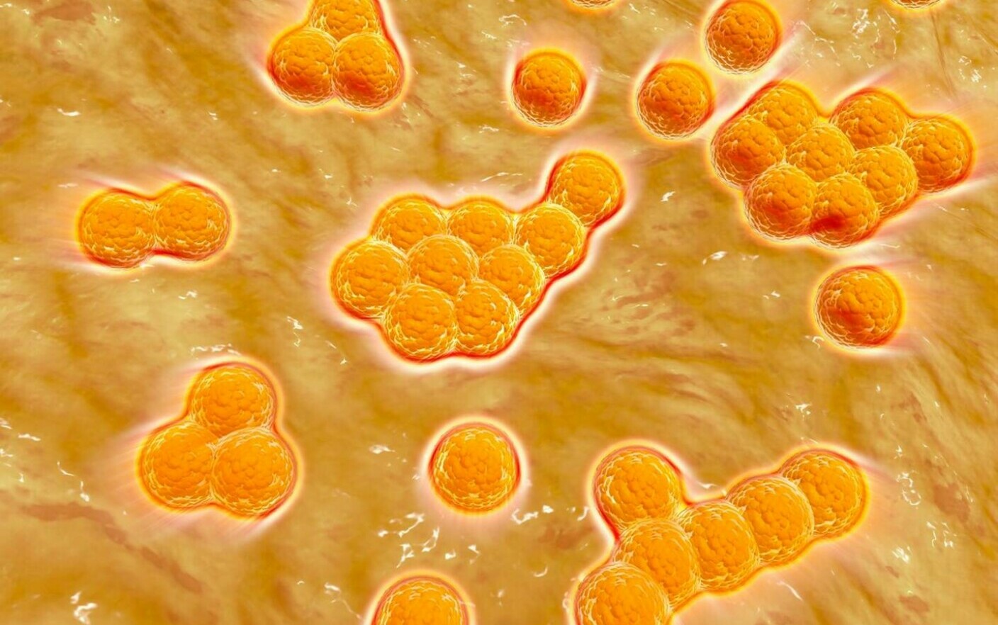 Stafilococul auriu, detectat în produsele servite la două petreceri din ...