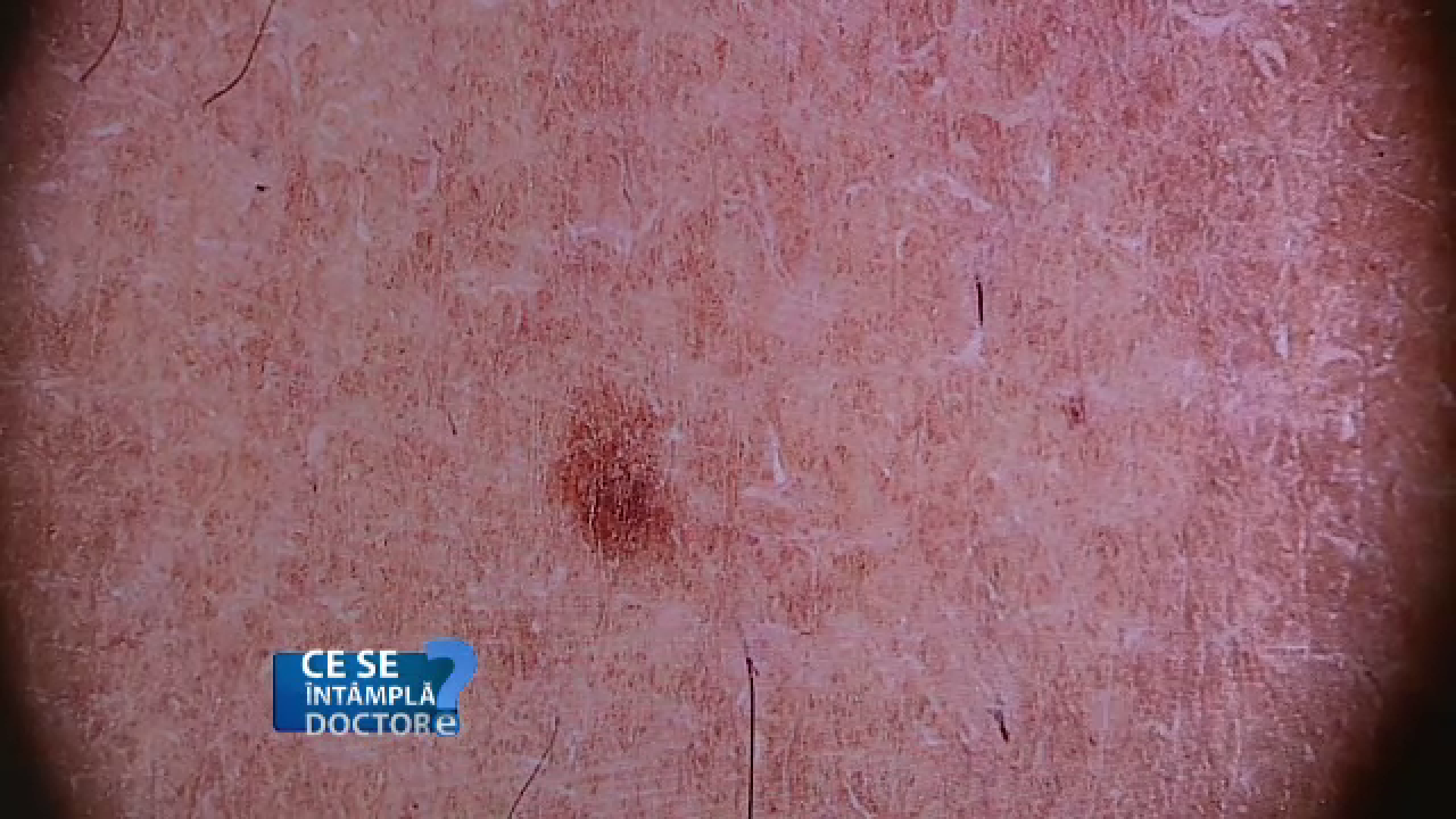 Cum arată cel mai periculos cancer de piele. Semnul pe care majoritatea ...