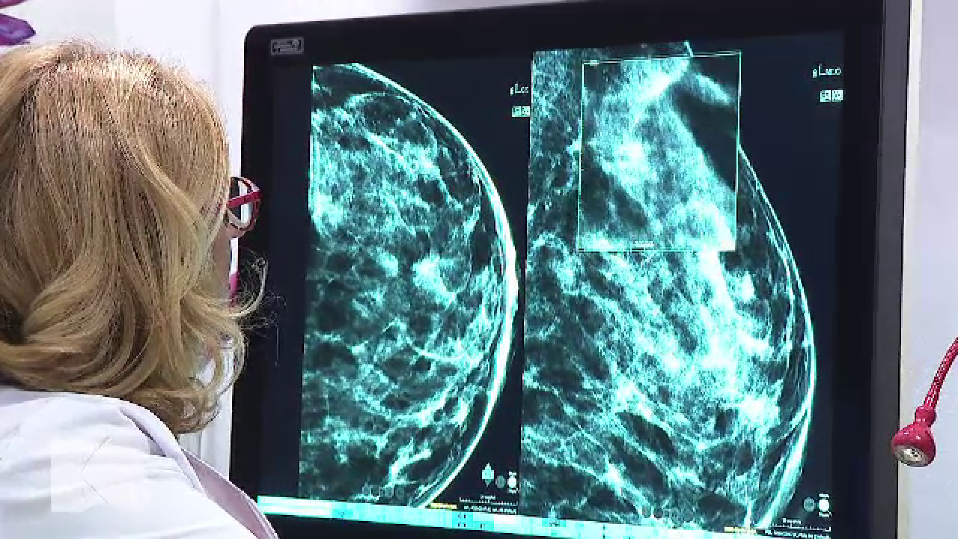 Cum poate fi diagnosticat cancerul la sân. Ce este și în ce condiții se ...