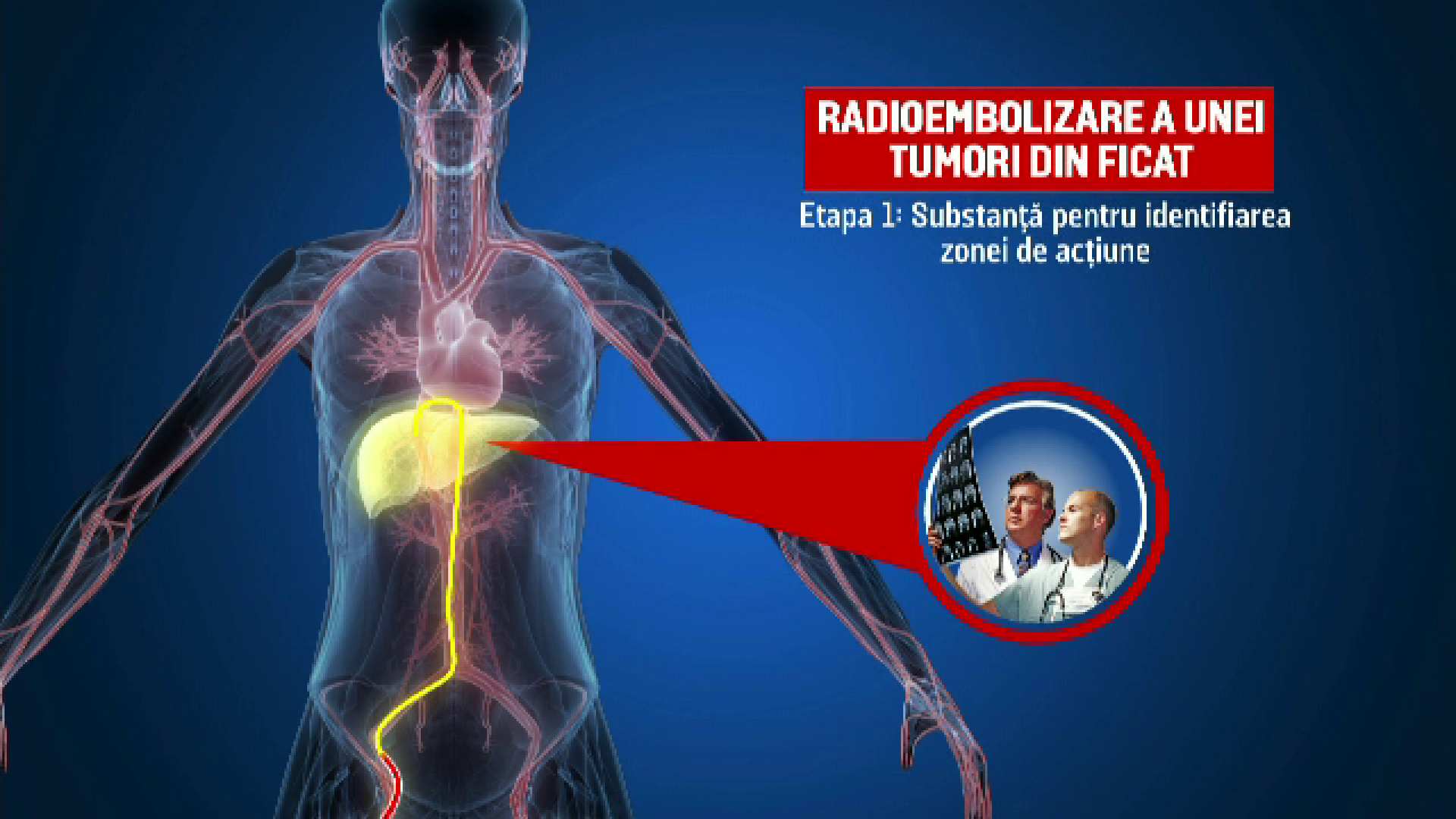 Premieră medicală în România. Un pacient bolnav de cancer de ficat a ...