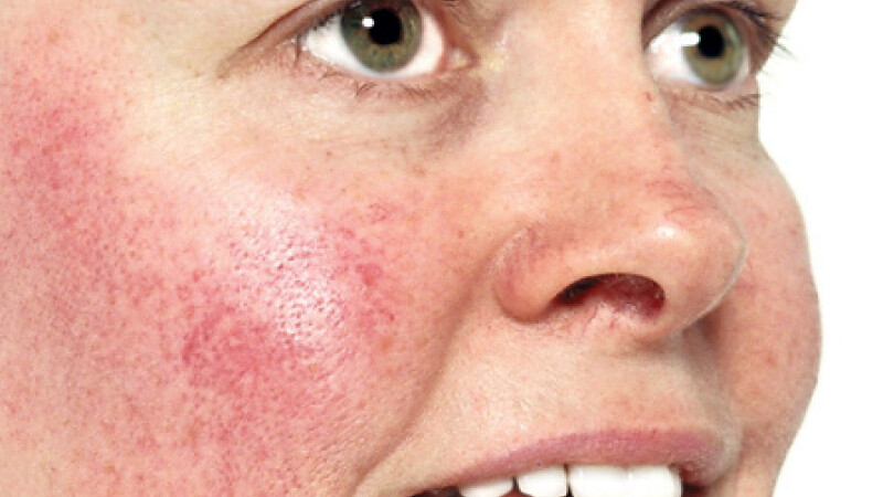 Pericolul de rozacee se instaleaza dupa 30 de ani! - Stirileprotv.ro