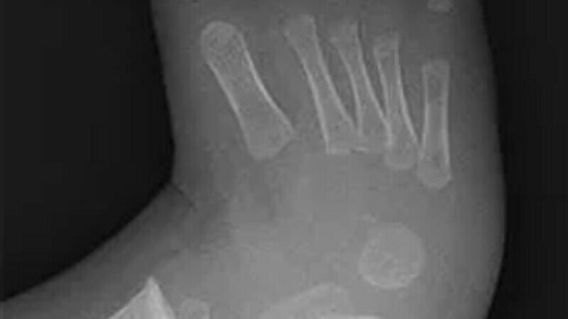 (P) Tratamentul pentru picior Varus Equin la bebeluși - Stirileprotv.ro