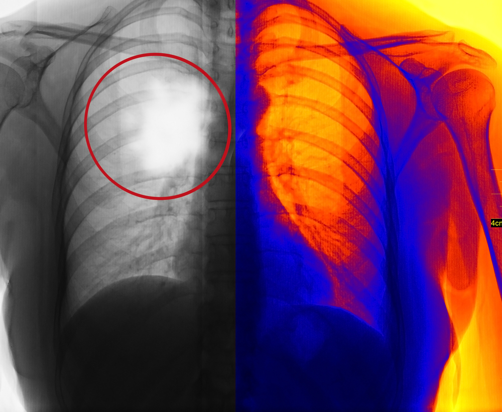 46% dintre bolnavii de cancer sunt diagnosticati prea tarziu. Studiul ...